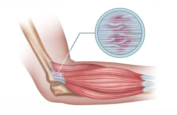 Tennis Elbow: Lateral Epicondylitis Symptoms & Treatments